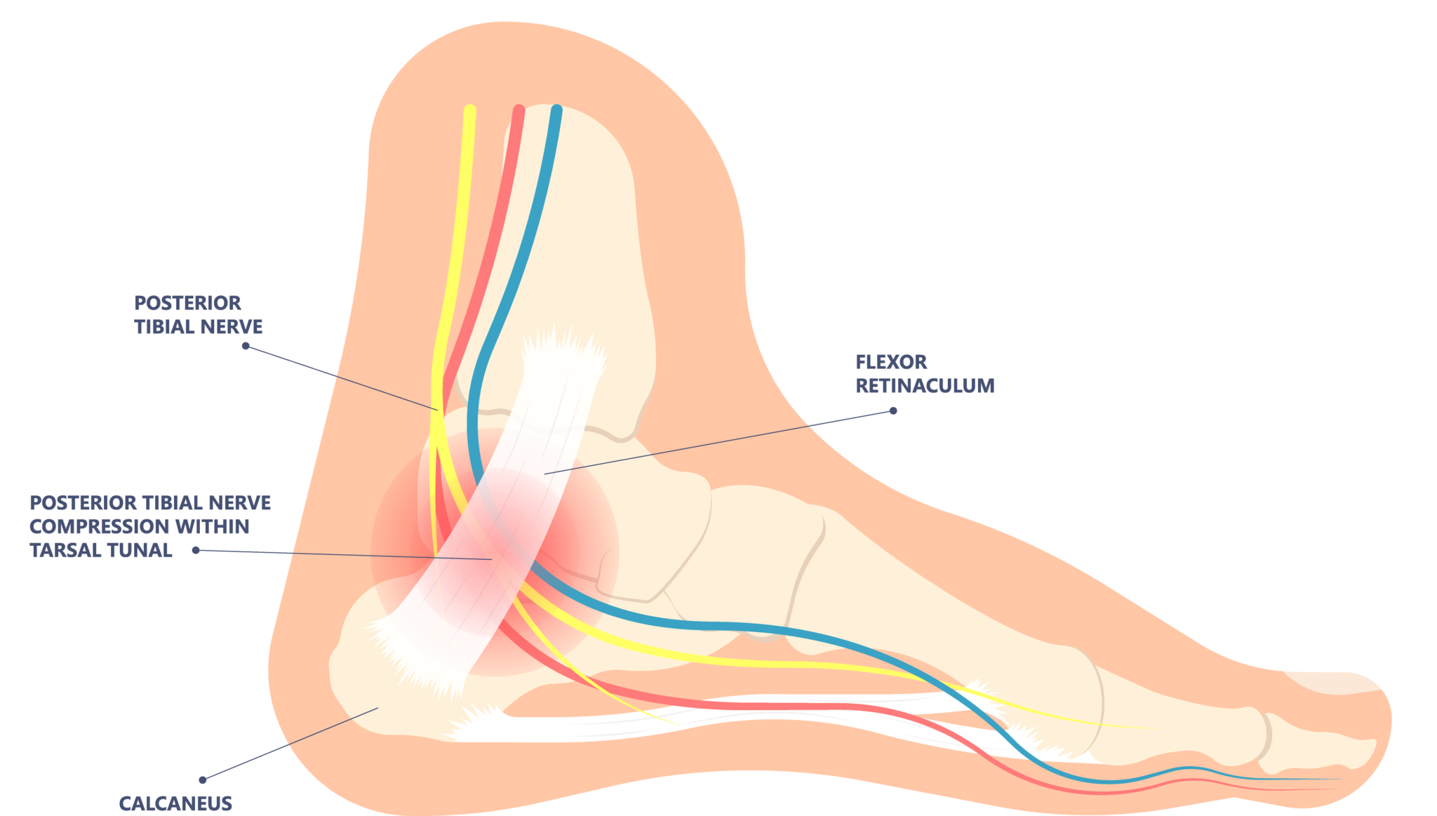 Live better by learning about Tarsal Tunnel Syndrome - Global Nerve Foundation